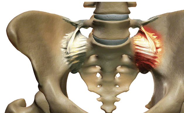 iFuse for SI Joint Pain in Birmingham, AL | Elite Orthopedics